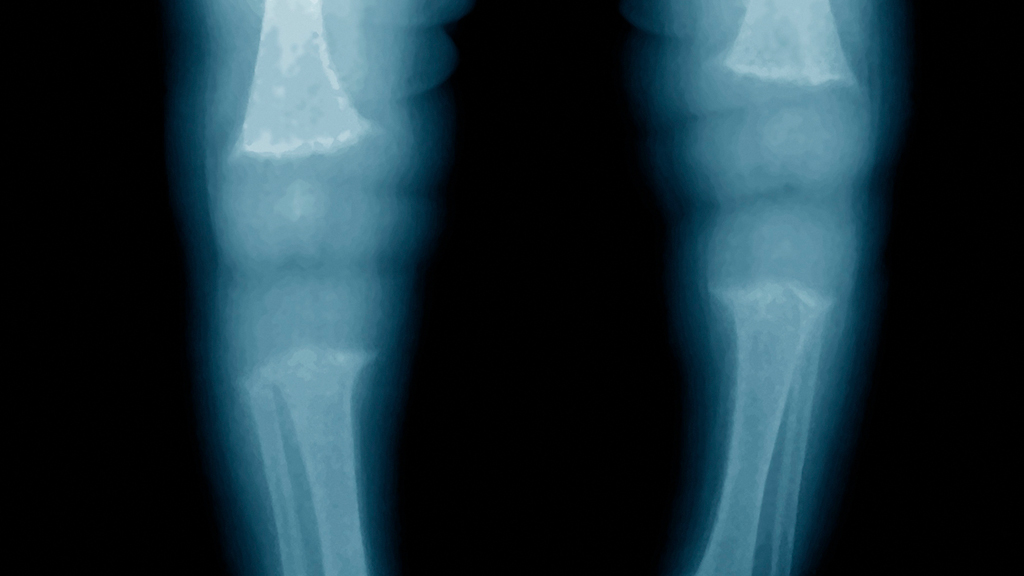 How rickets is making a comeback – Channel 4 News