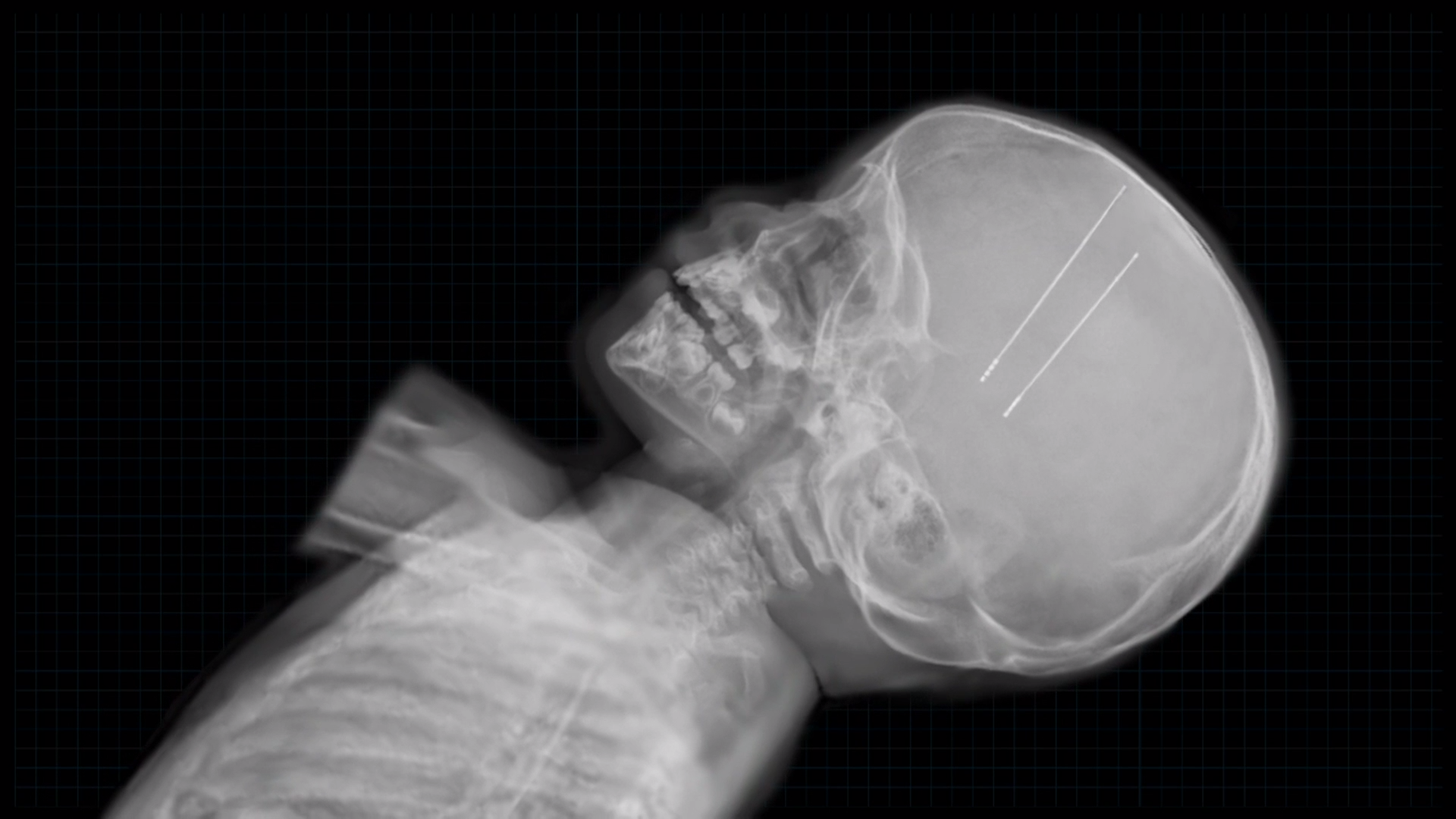 Two-year-old becomes youngest child in world to have groundbreaking ...