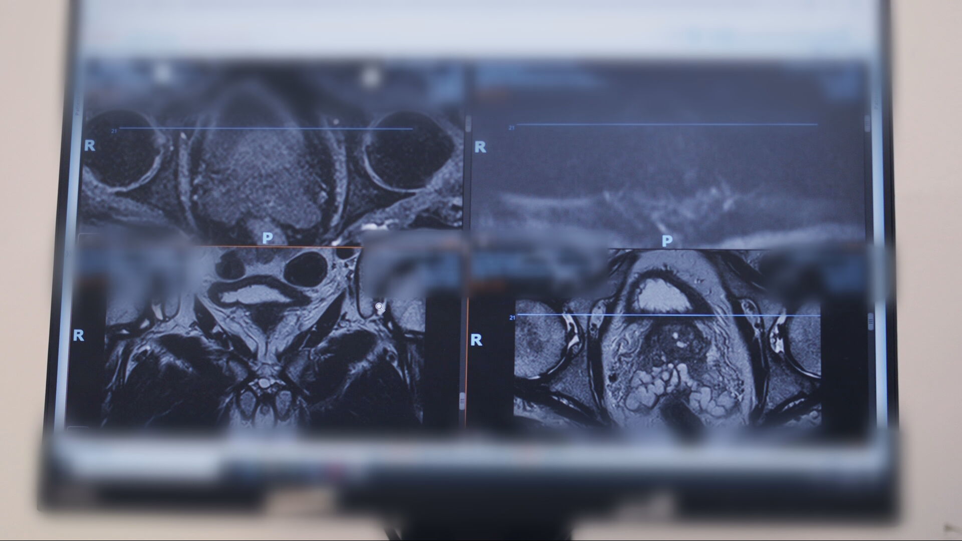 Prostate cancer screening gets major boost from MRI scan breakthrough ...